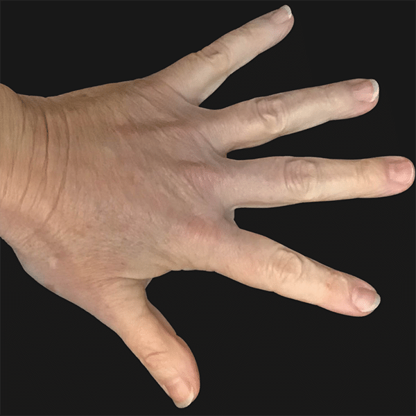 Dermal Fillers Gallery | RejuvenationMD | Med Spa | Bellingham ...